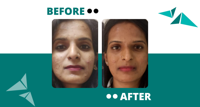 Skin Lightening Treatment